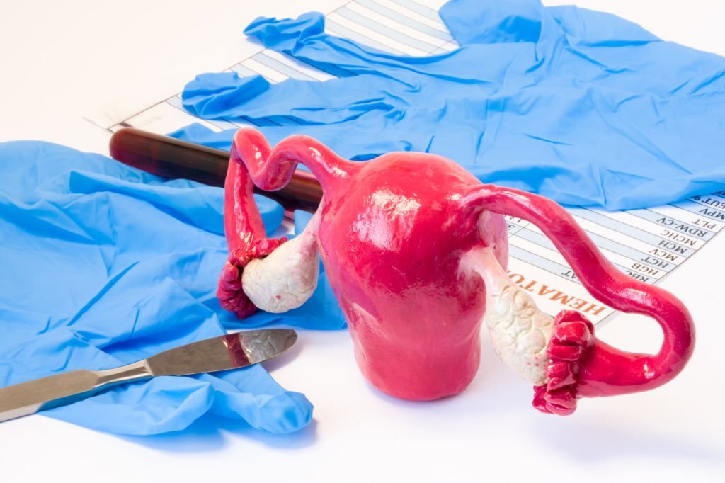 Myomectomy Surgery, Nagpur | Fibroid Removal Surgery, Nagpur